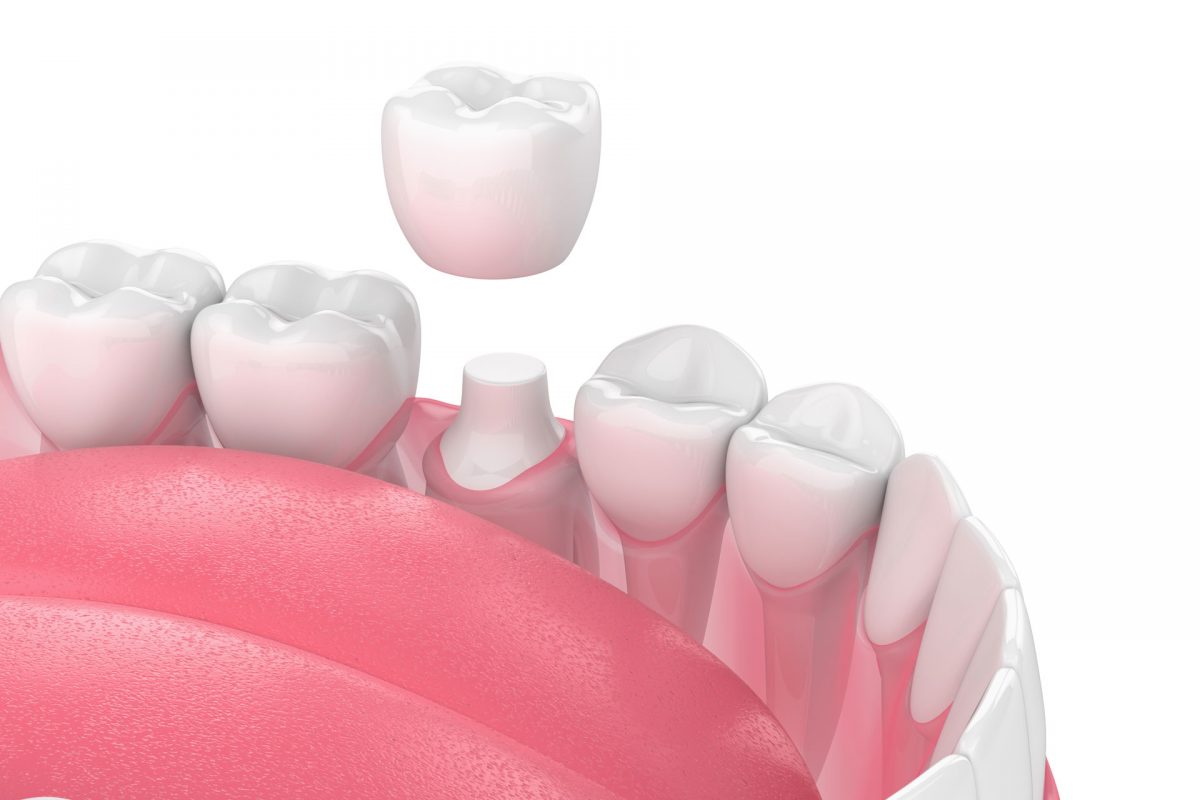 Same-Day Crowns With CEREC In Phoenix - Corner Dentistry