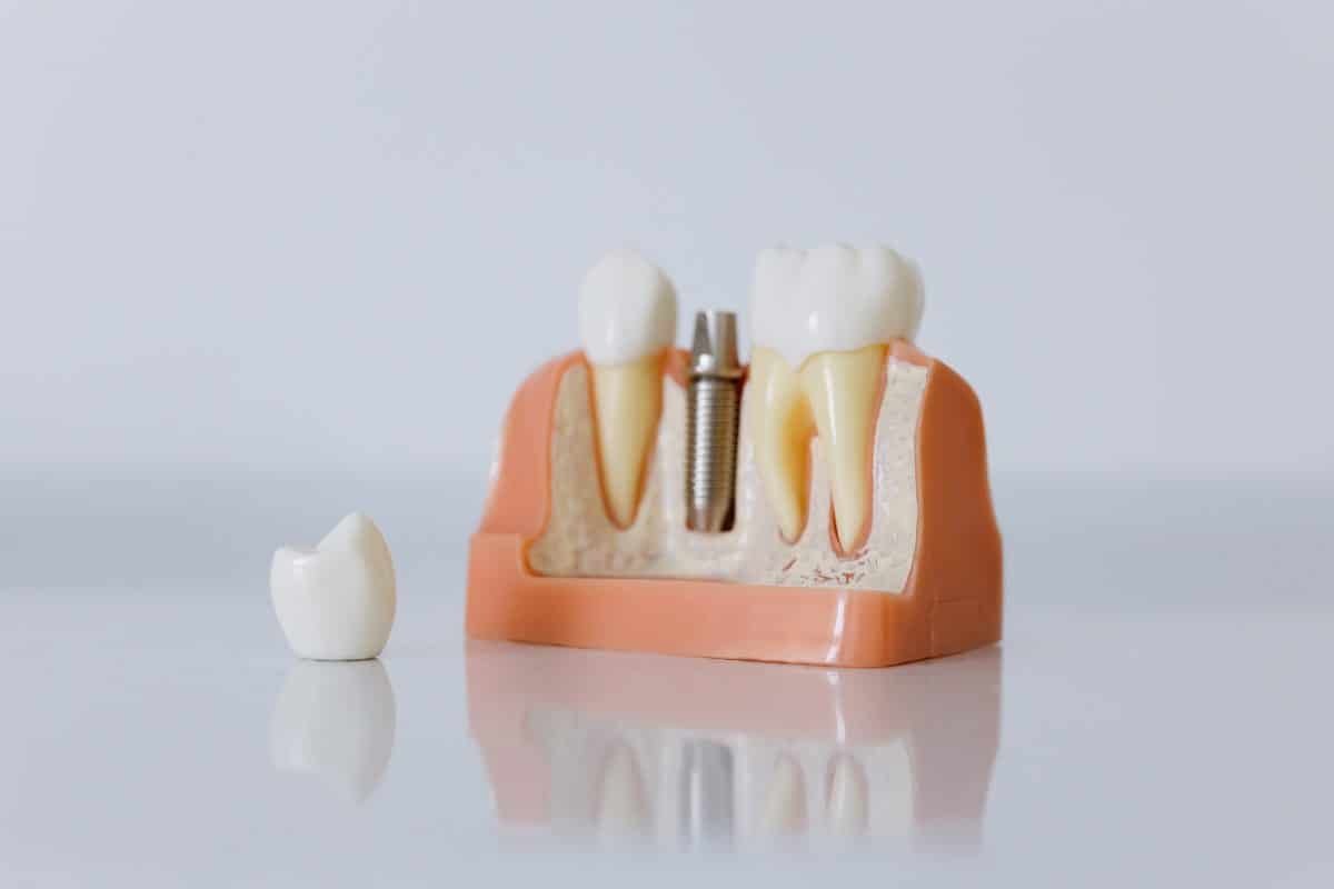 Full Mouth Reconstruction - Who Needs One & What To Expect