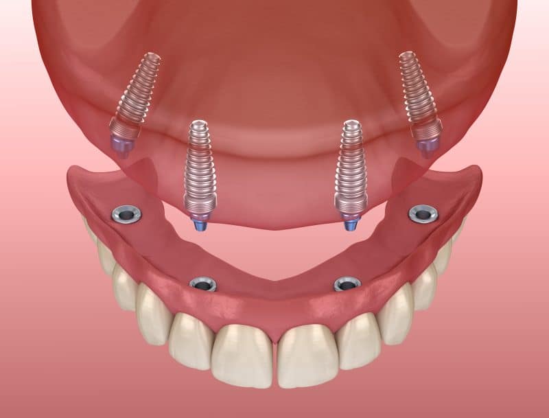 What Are The Four Types Of Dental Implants?