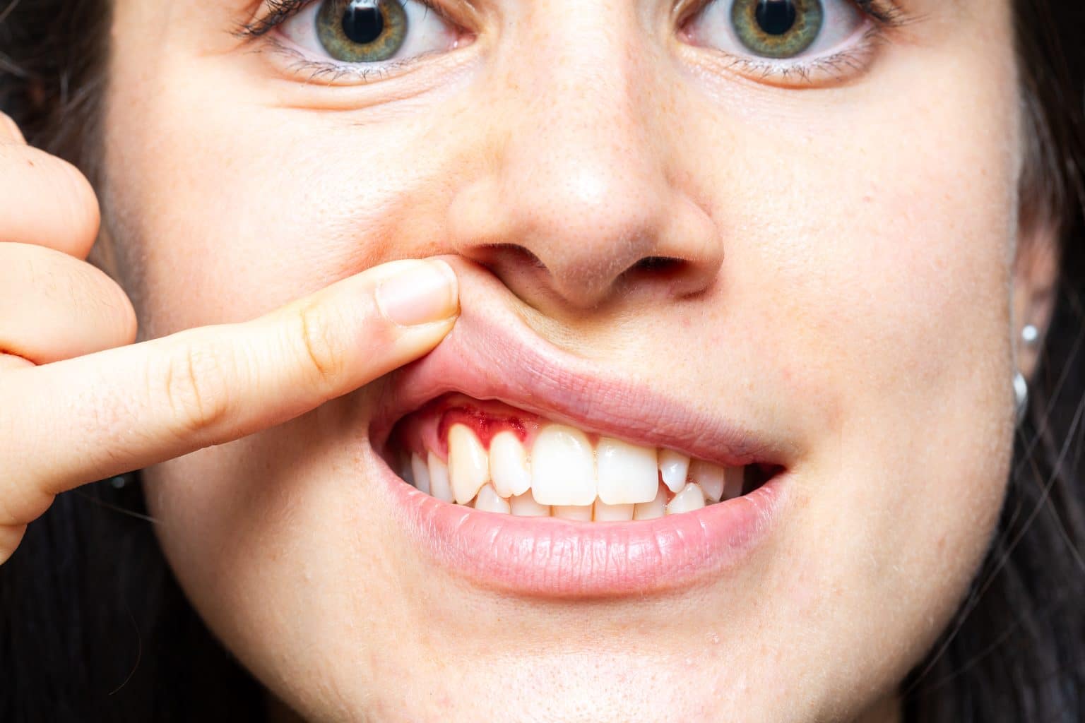 Can Gums Grow Back From Gum Recession?