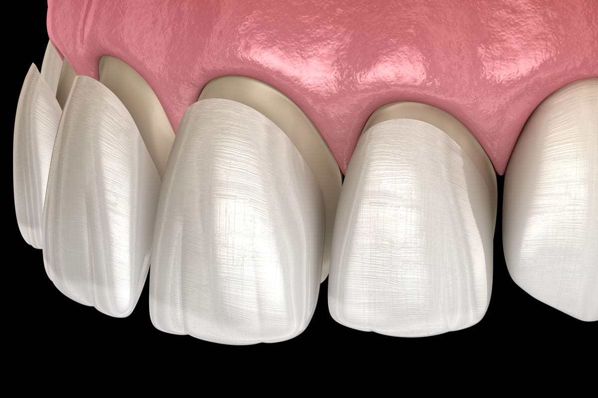 Composite Vs Porcelain Veneers: Which One Is Best For You?